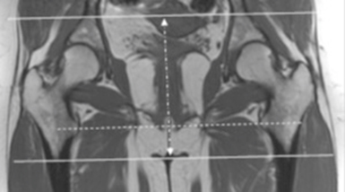 MR Hip W/WO - Unilateral or Bilateral MSK Protocol | OHSU